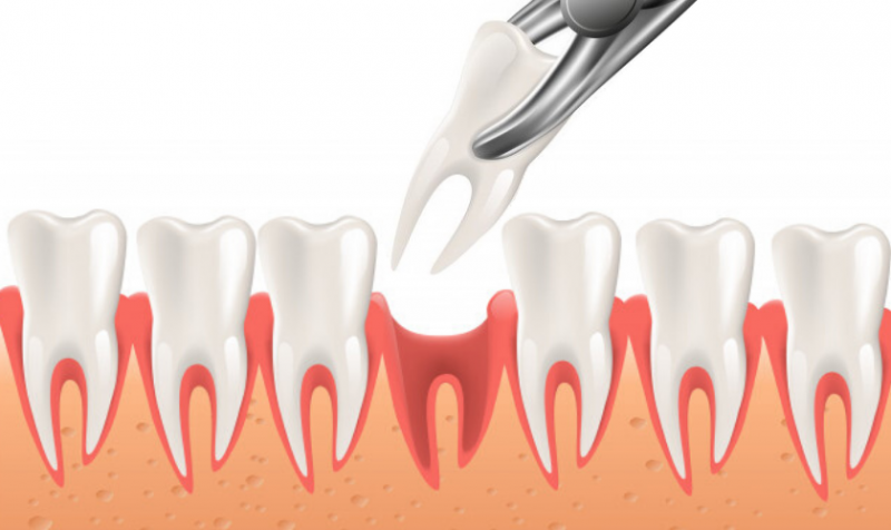 Painless Tooth Extraction in Dwarka | Expert Extract Wisdom Tooth ...